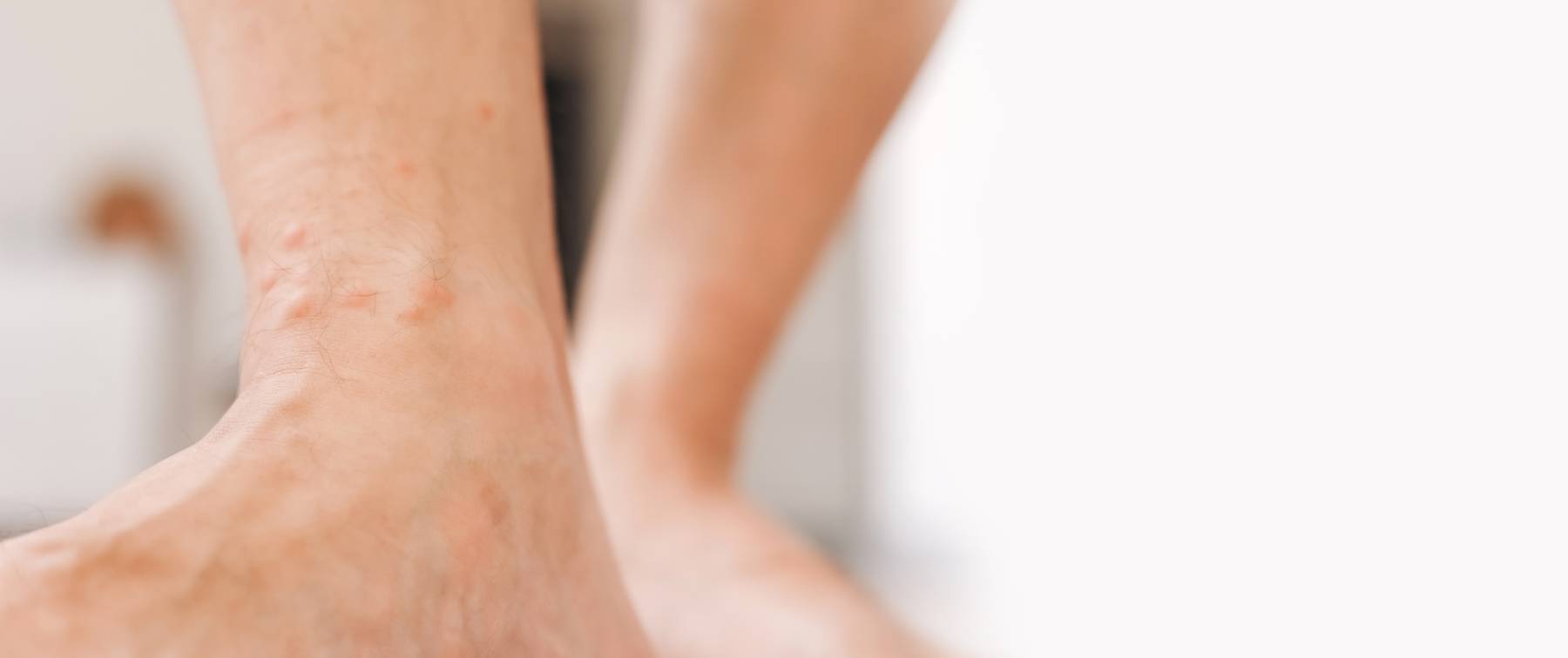 Eczema Specialist in Bangalore | Dr. Rajdeep Mysore