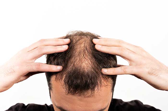 Baldness Treatment in Bangalore | Baldness Treatment Cost in Bangalore