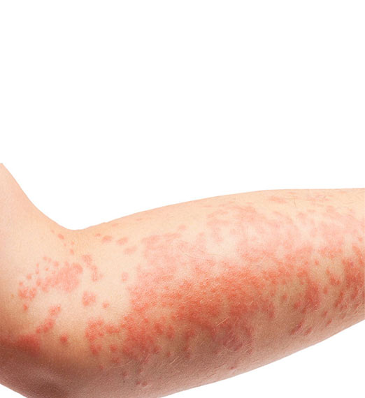 Skin Allergy Treatment in Bangalore, JP Nagar | Eczema Treatment in ...