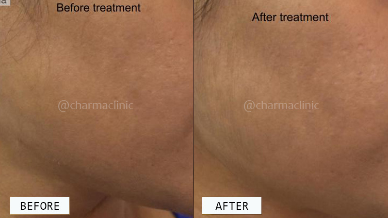 Laser Toning Results | Before and After | Charma Clinic