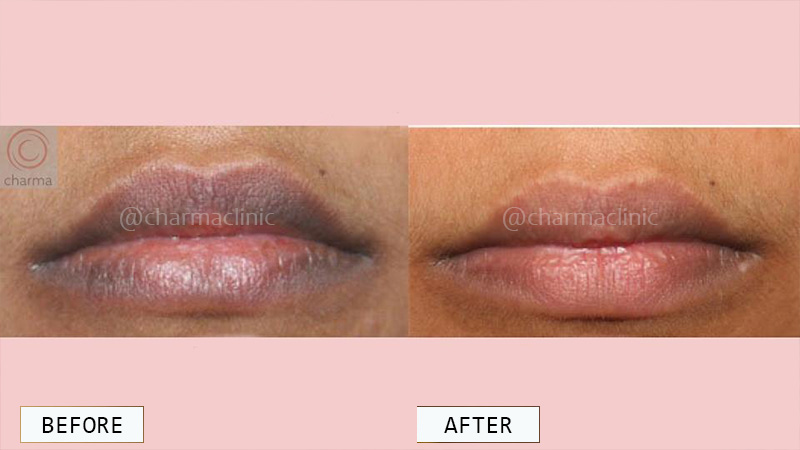 Lip Pigmentation Results | Before and After | Charma Clinic
